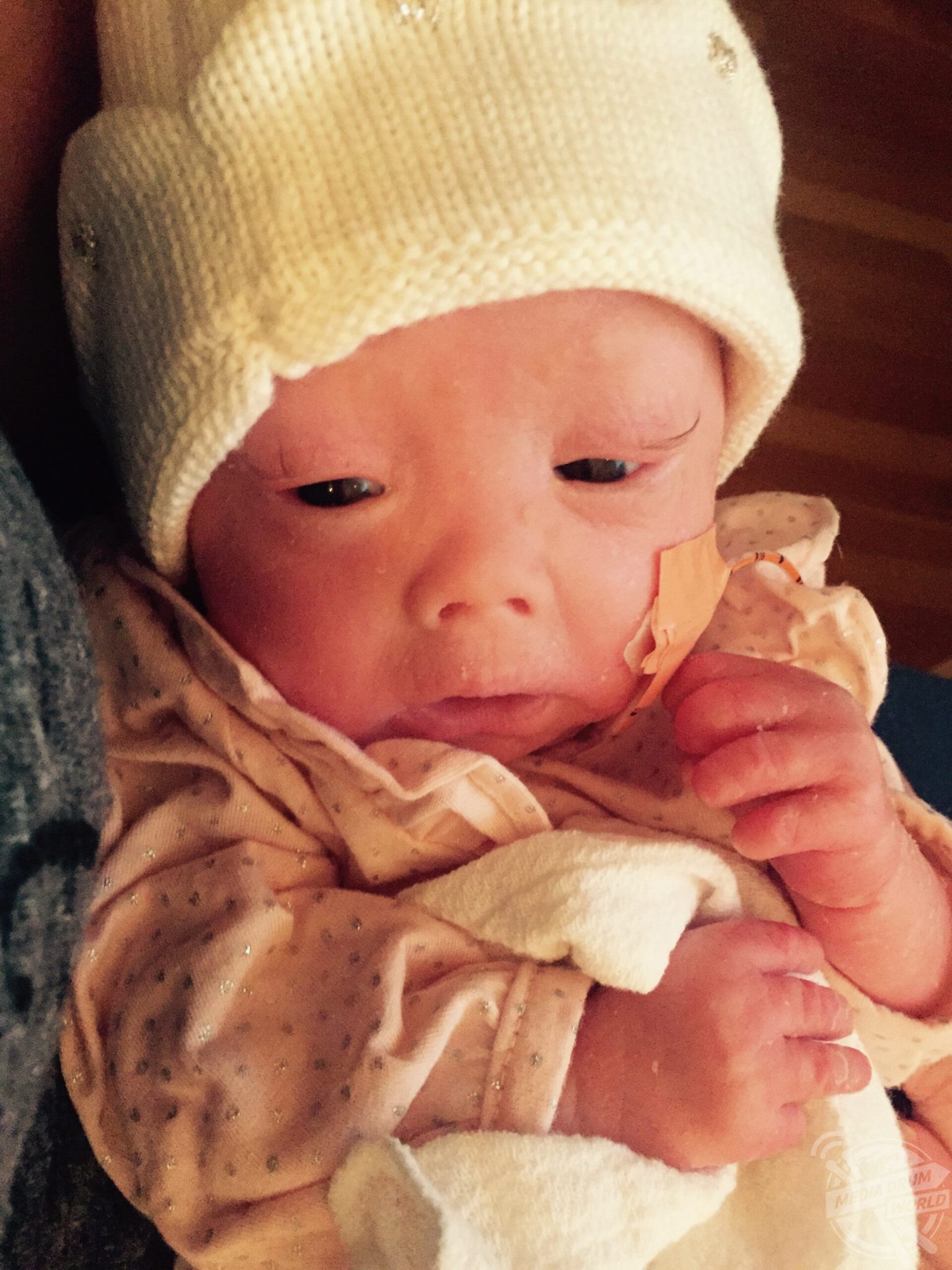 Harlequin Ichthyosis Child Model - Media Drum World