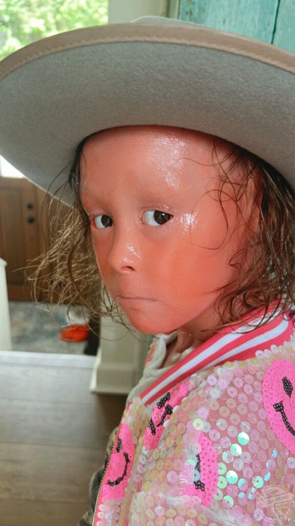 Harlequin Ichthyosis Child Model - Media Drum World